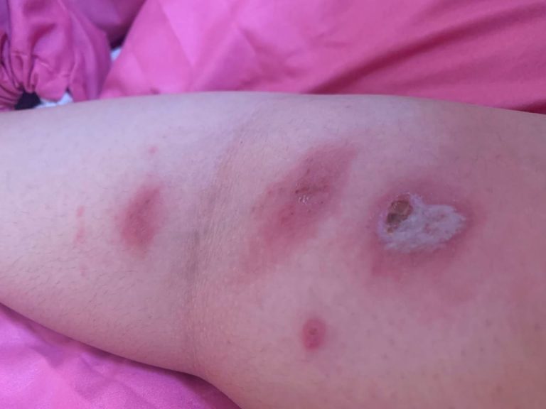 Gejala Awal Terkena Racun Tomcat, Perhatikan! - Teropong Media